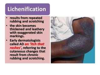 Atopic dermatitis by Dr.Gamal Soltan | PPSX