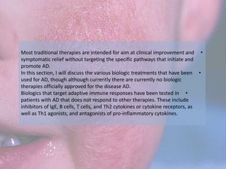 Biological Treatment of Atopic Dermatitis | PPTX