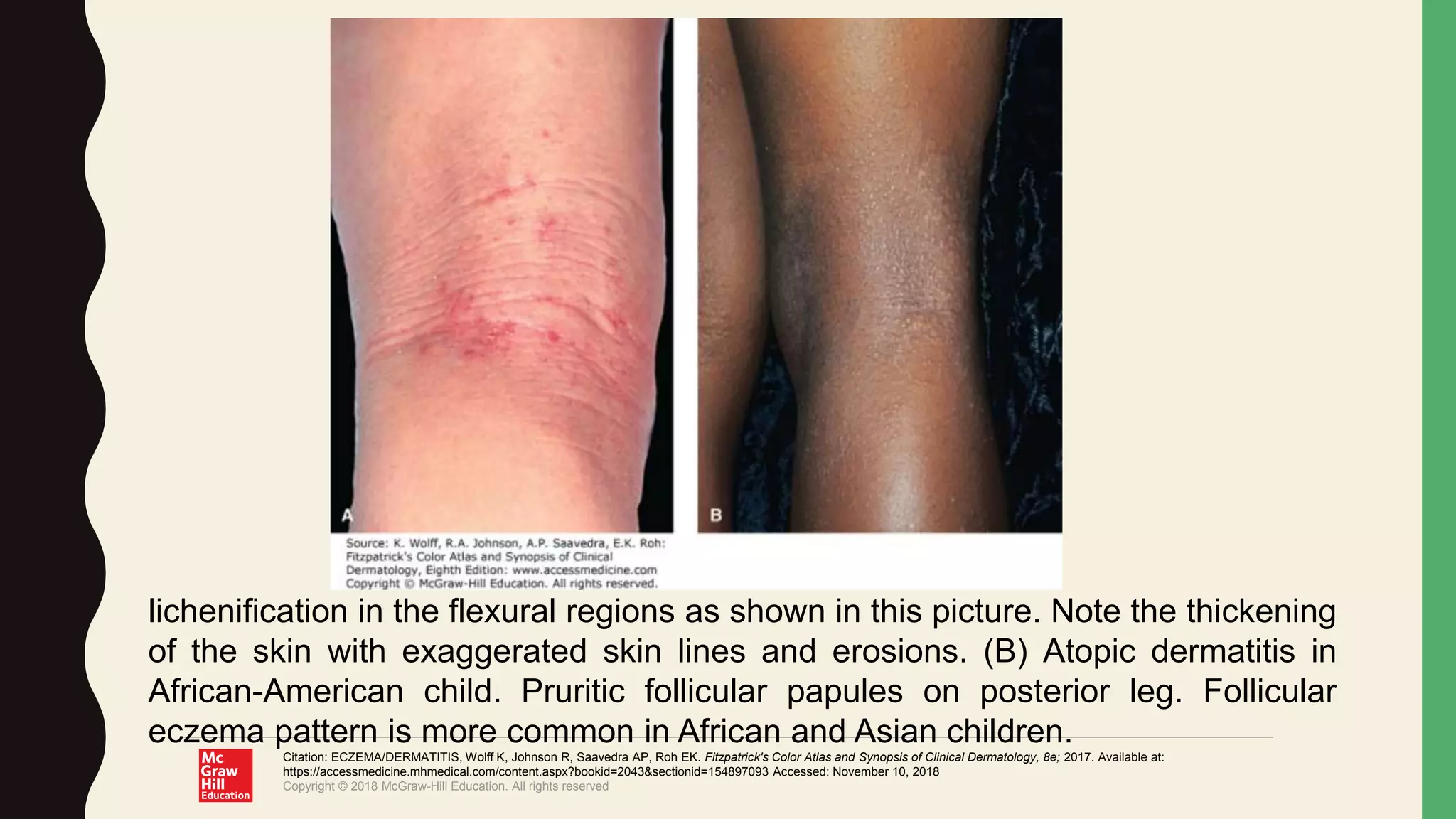 Atopic dermatitis | PPTX | Skin and Dermatology | Diseases and Conditions