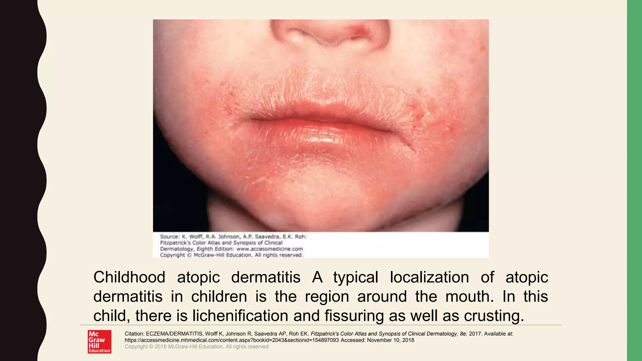 Atopic dermatitis | PPTX | Skin and Dermatology | Diseases and Conditions