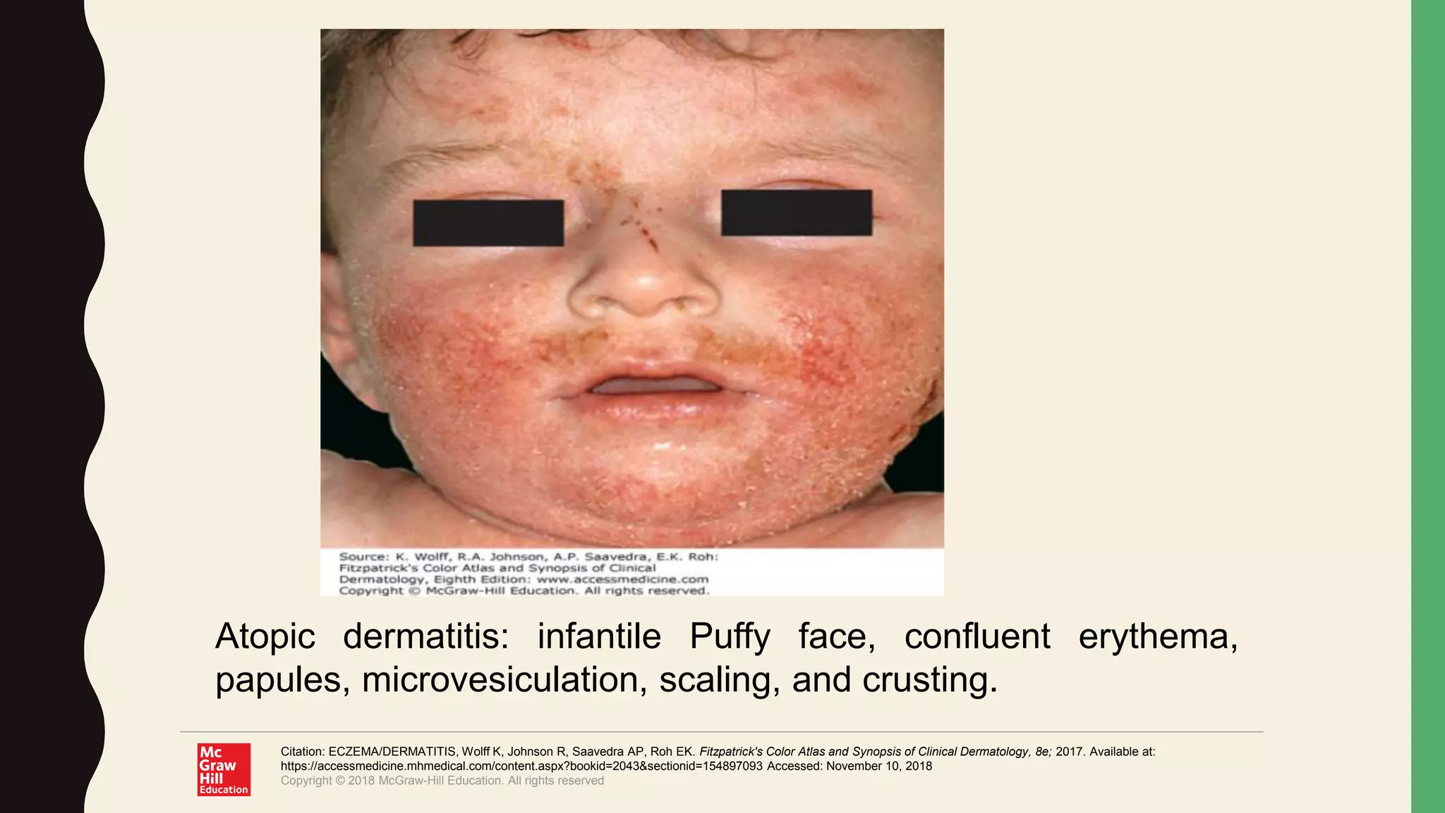 Atopic dermatitis | PPTX | Skin and Dermatology | Diseases and Conditions