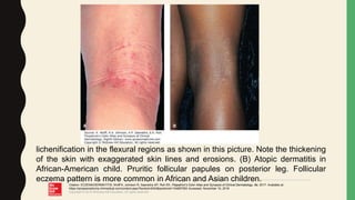 Atopic dermatitis | PPTX | Skin and Dermatology | Diseases and Conditions