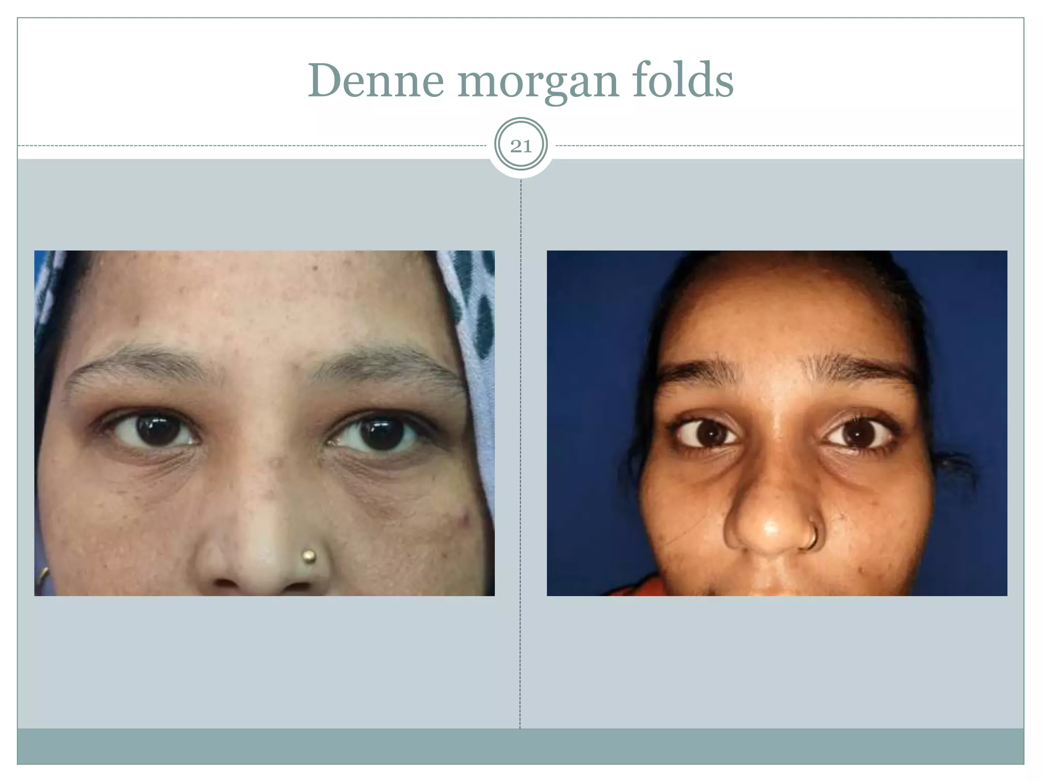 Atopic dermatitis | PPTX