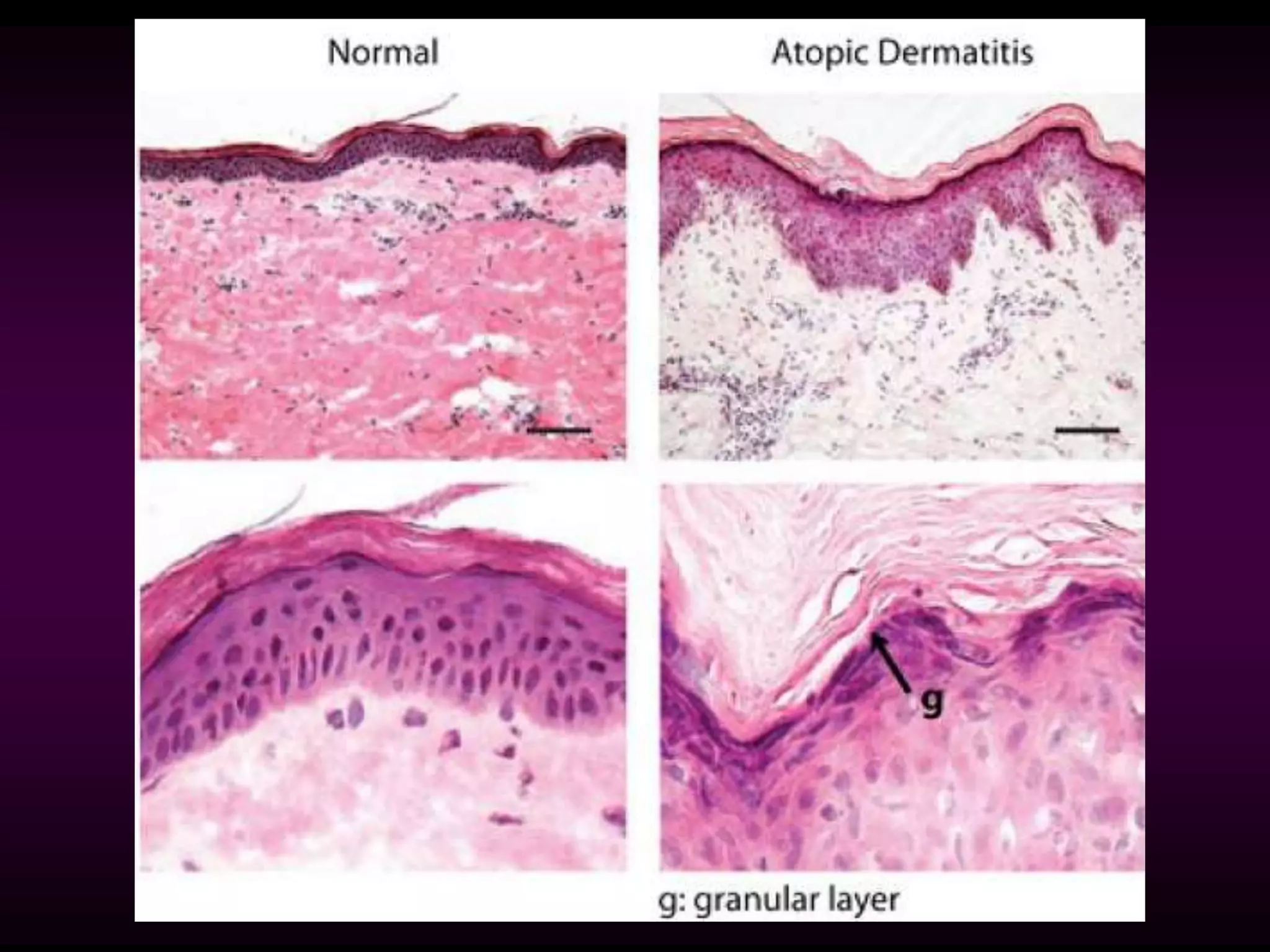 Atopic dermatitis | PPT