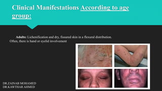 Atopic dermatitis | PPTX