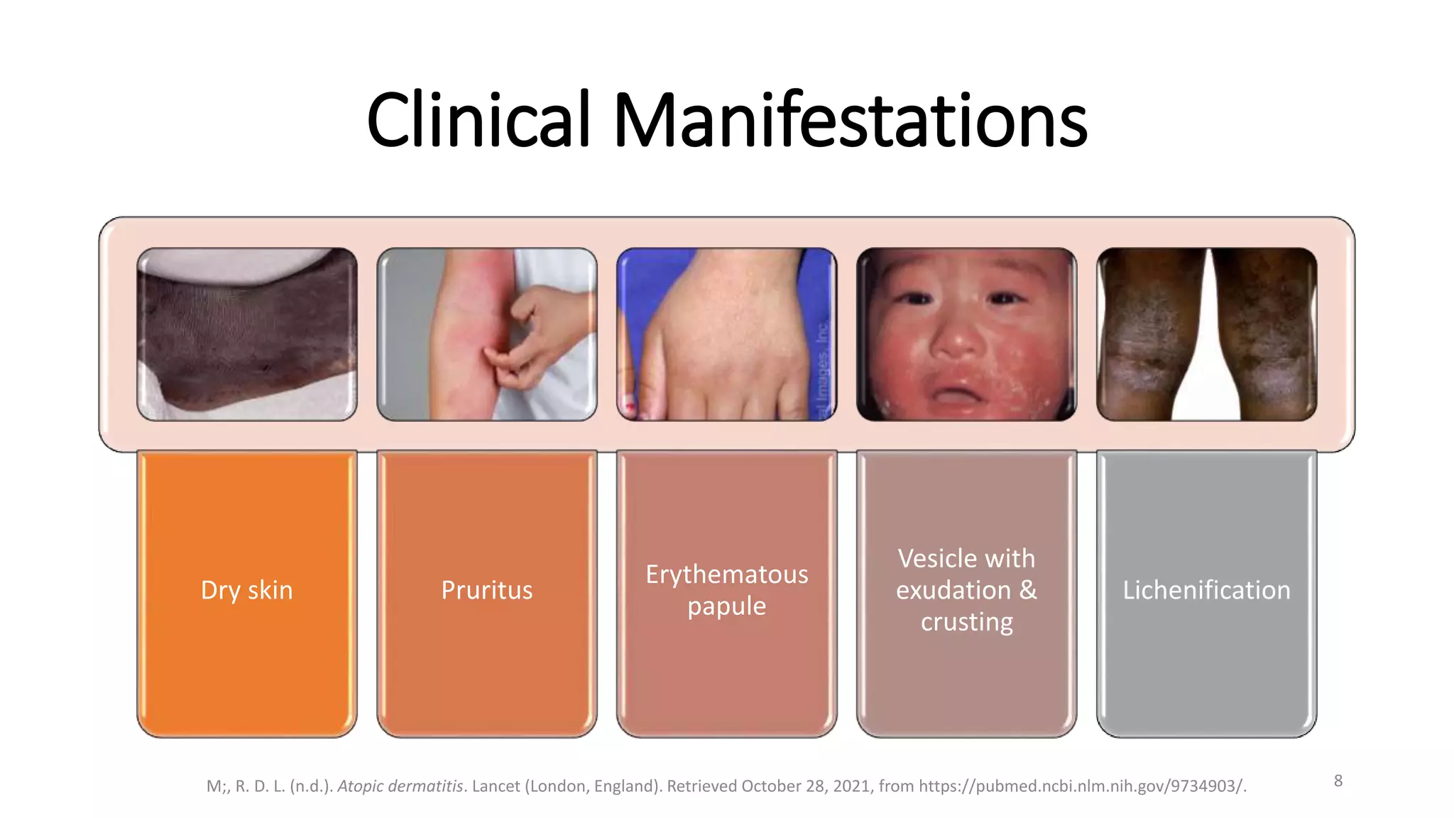 Atopic Dermatitis.pptx
