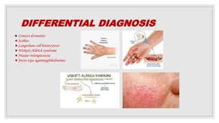 ATOPIC DERMATITIS.pptx