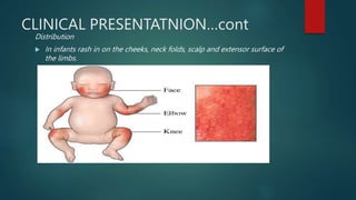 ATOPIC DERMATITIS in children. dx and tx | PPTX | Skin and Dermatology ...
