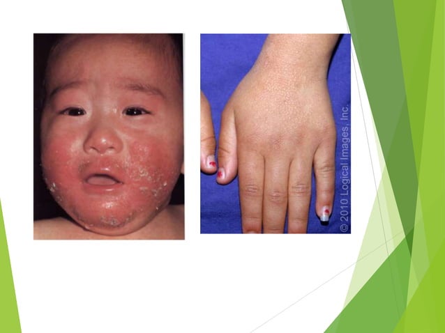 Atopic Dermatitis Atopic Dermatitis Atopic | PPT | Allergies | Diseases ...