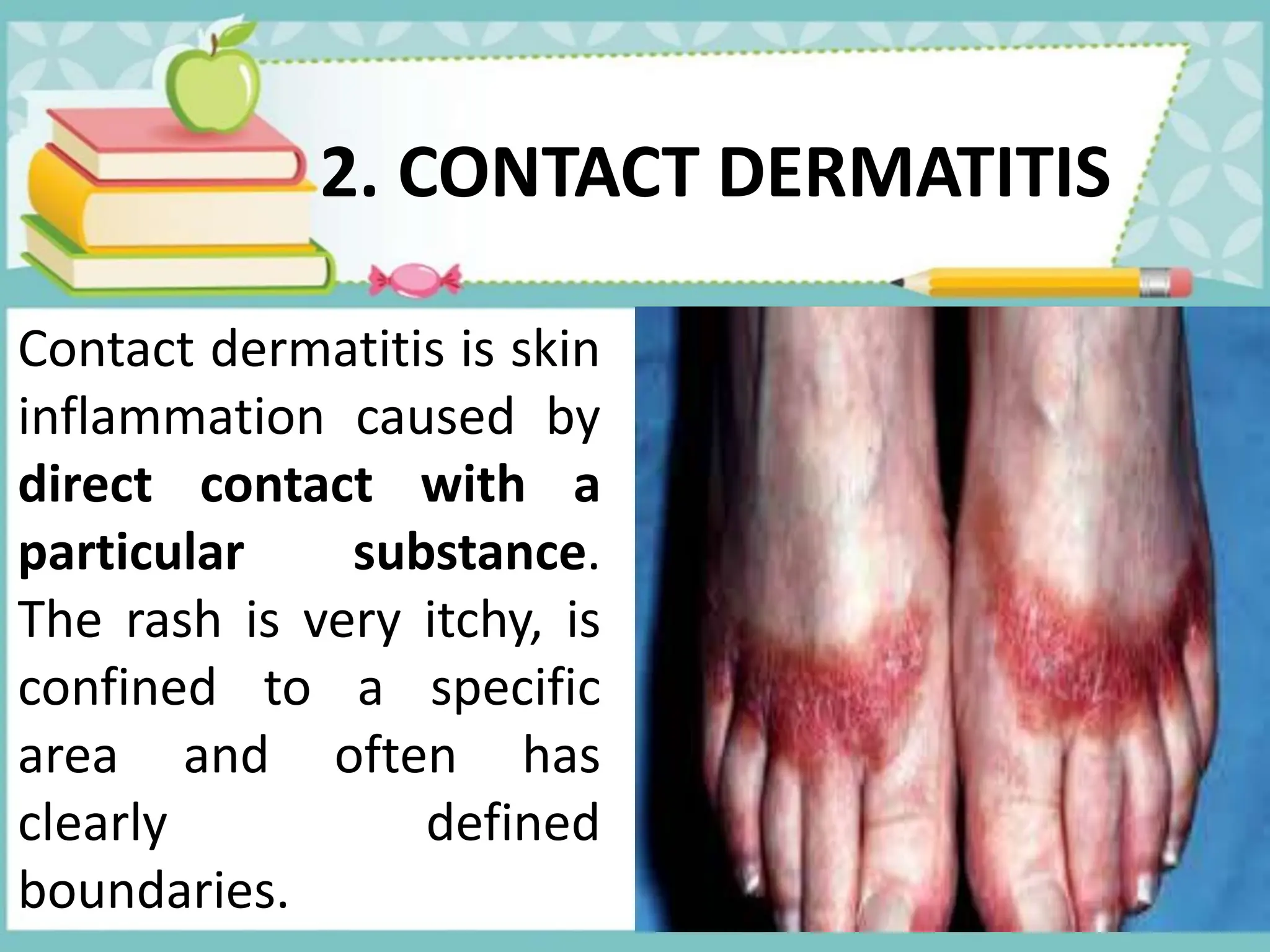 Atopic Dermatitis.pptx dermatitis skin inf | PPTX