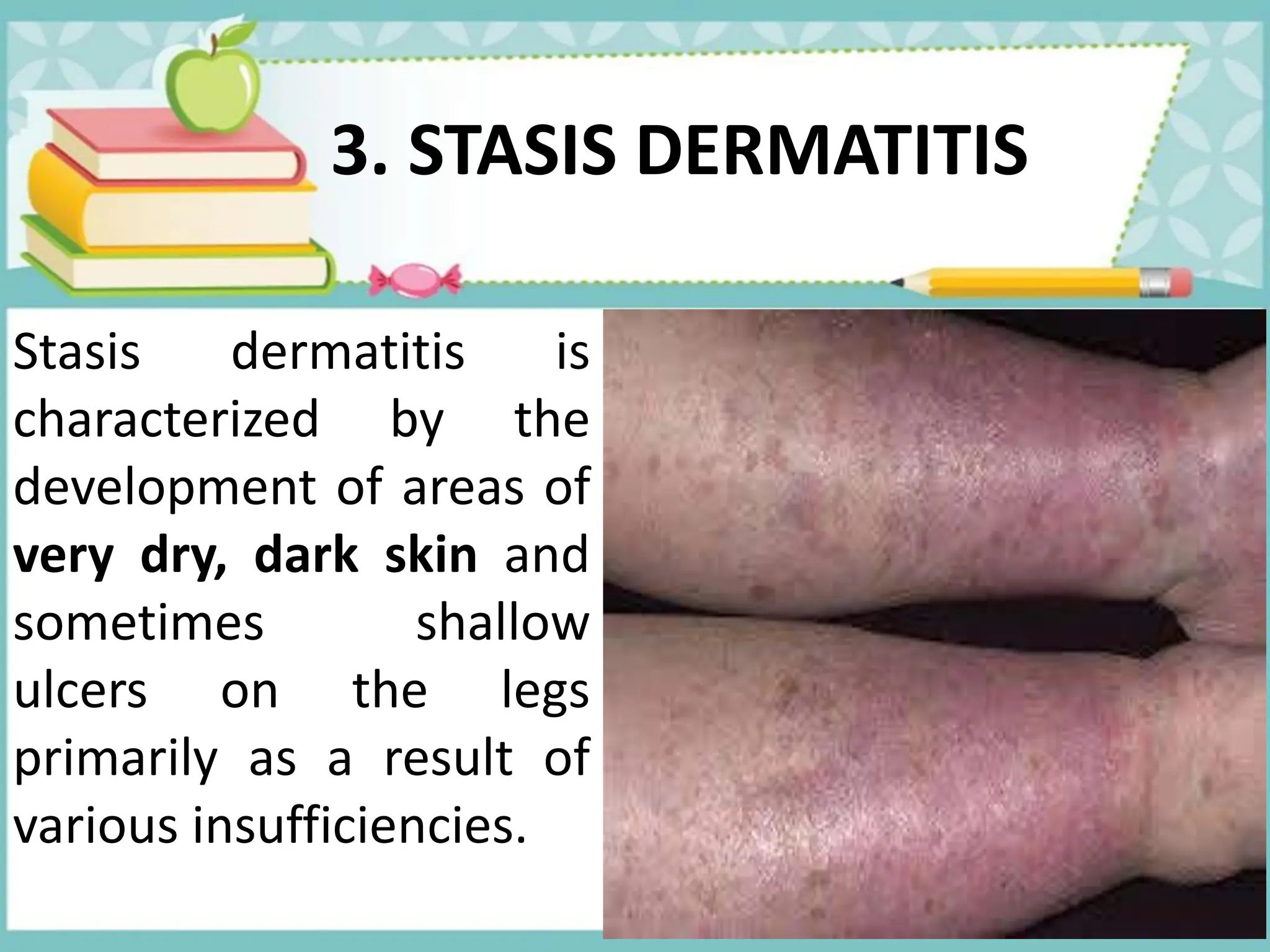 Atopic Dermatitis Pptx Dermatitis Skin Inf Pptx