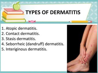 Atopic Dermatitis.pptx dermatitis skin inf | PPTX