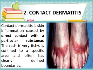 Atopic Dermatitis.pptx dermatitis skin inf | PPTX