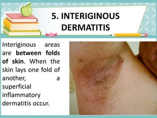 Atopic Dermatitis.pptx dermatitis skin inf | PPTX