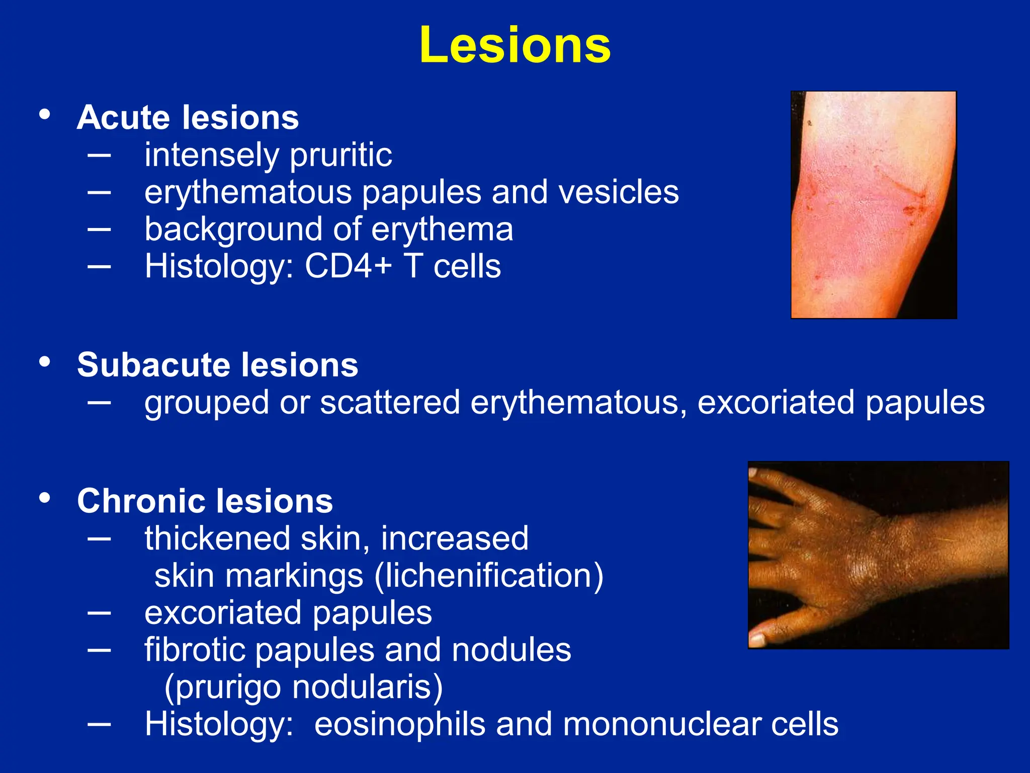 Atopic dermatitis.pdf for allergy learning | PDF