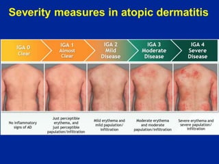 Atopic dermatitis.pdf for allergy learning | PDF