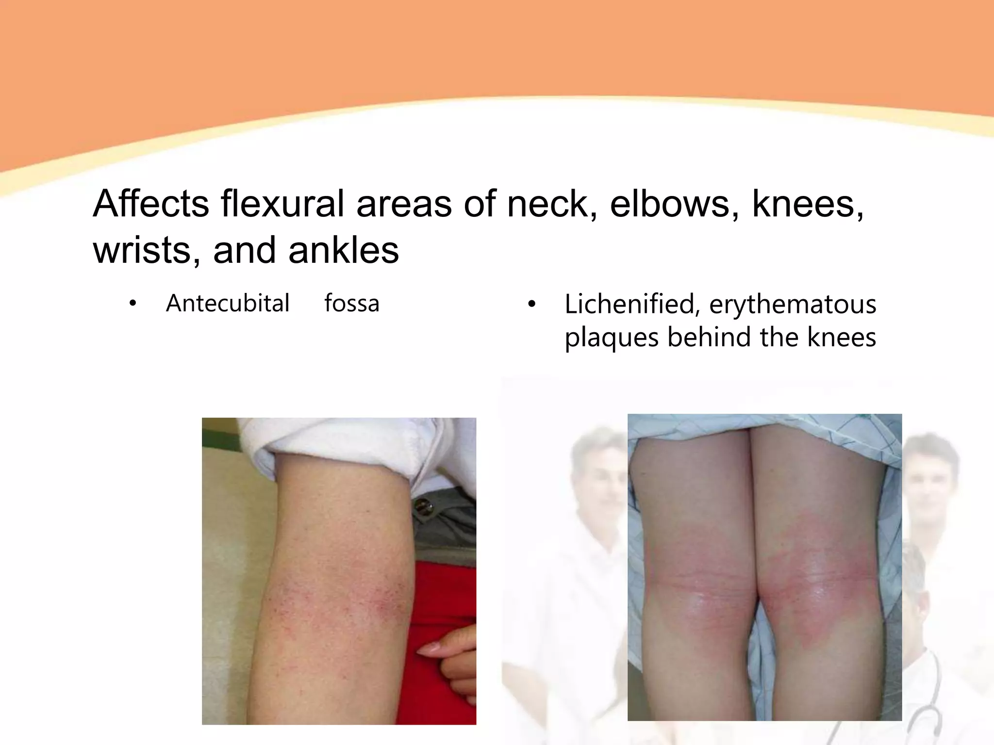 Atopic dermatitis(Eczema) | PPTX