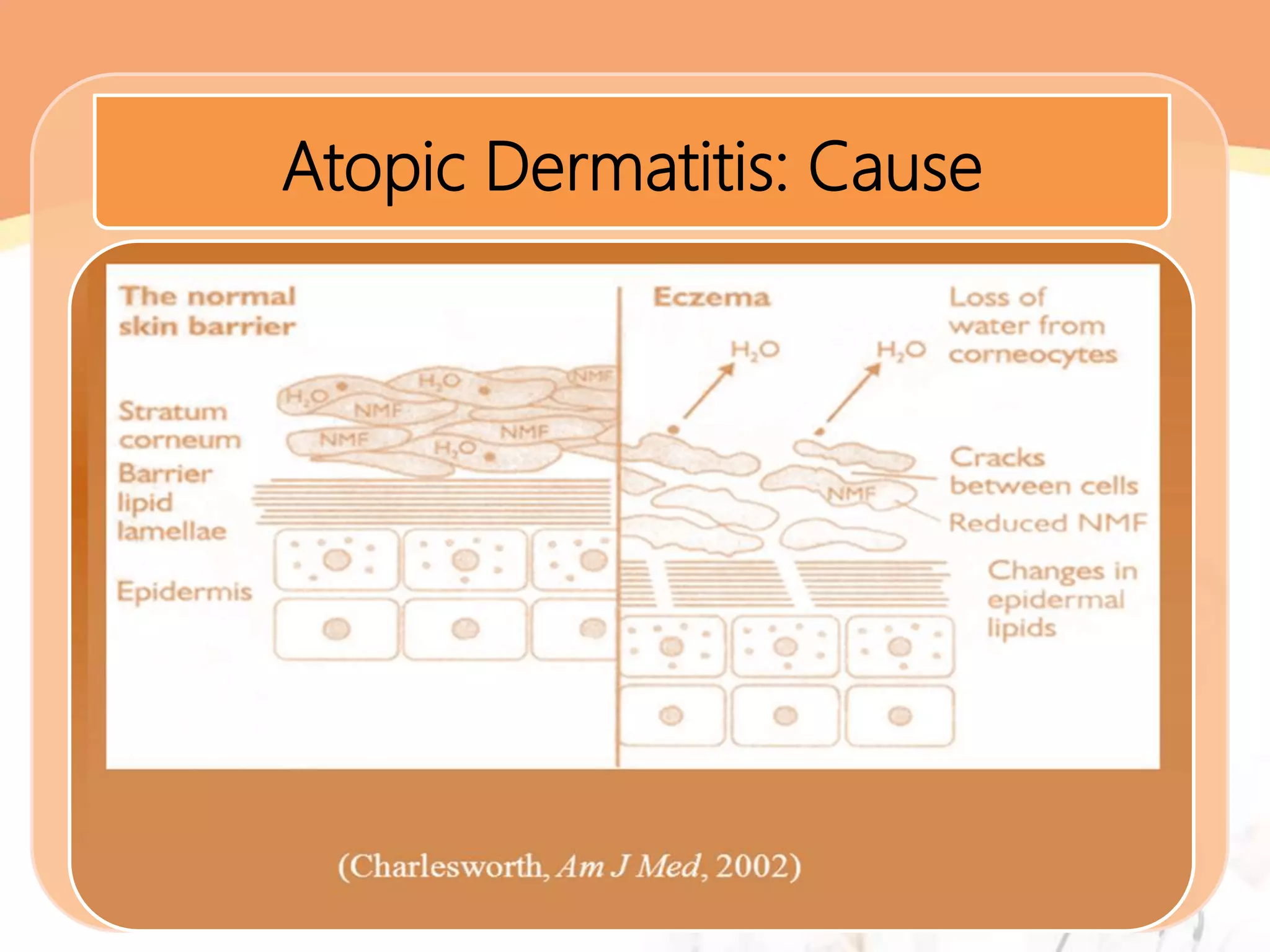 Atopic dermatitis(Eczema) | PPTX