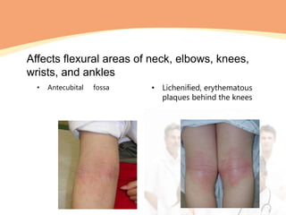 Atopic dermatitis(Eczema) | PPTX