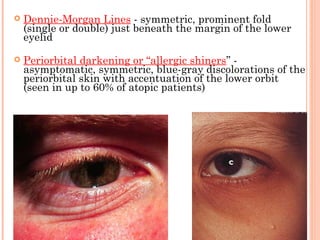 Atopic dermatitis1 | PPT