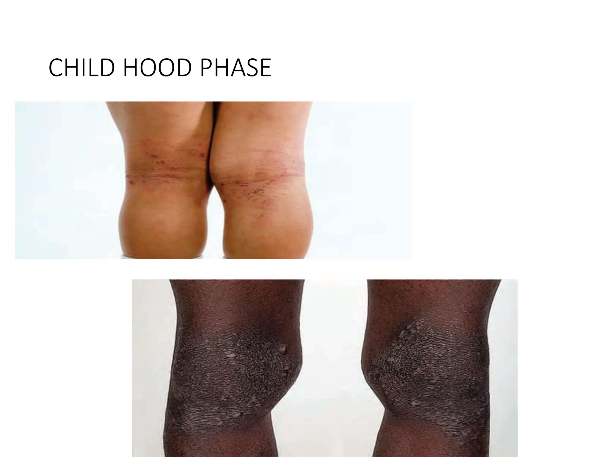 Pathogenesis clinical features and management of Atopic dermatitis ...
