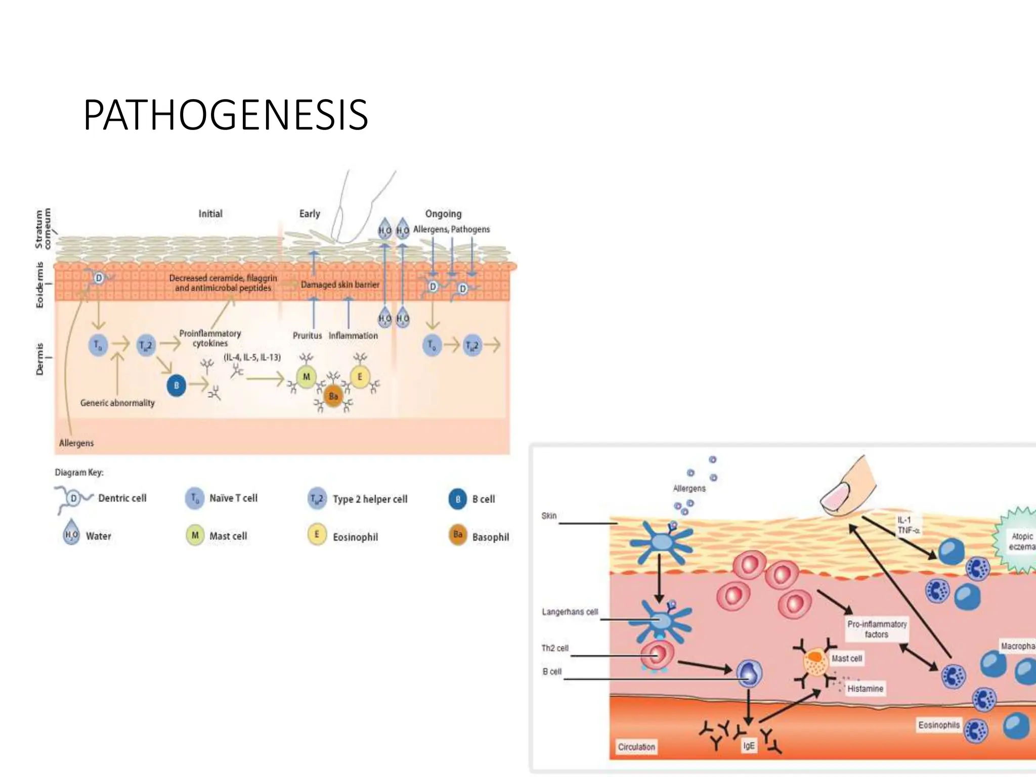 Pathogenesis clinical features and management of Atopic dermatitis ...