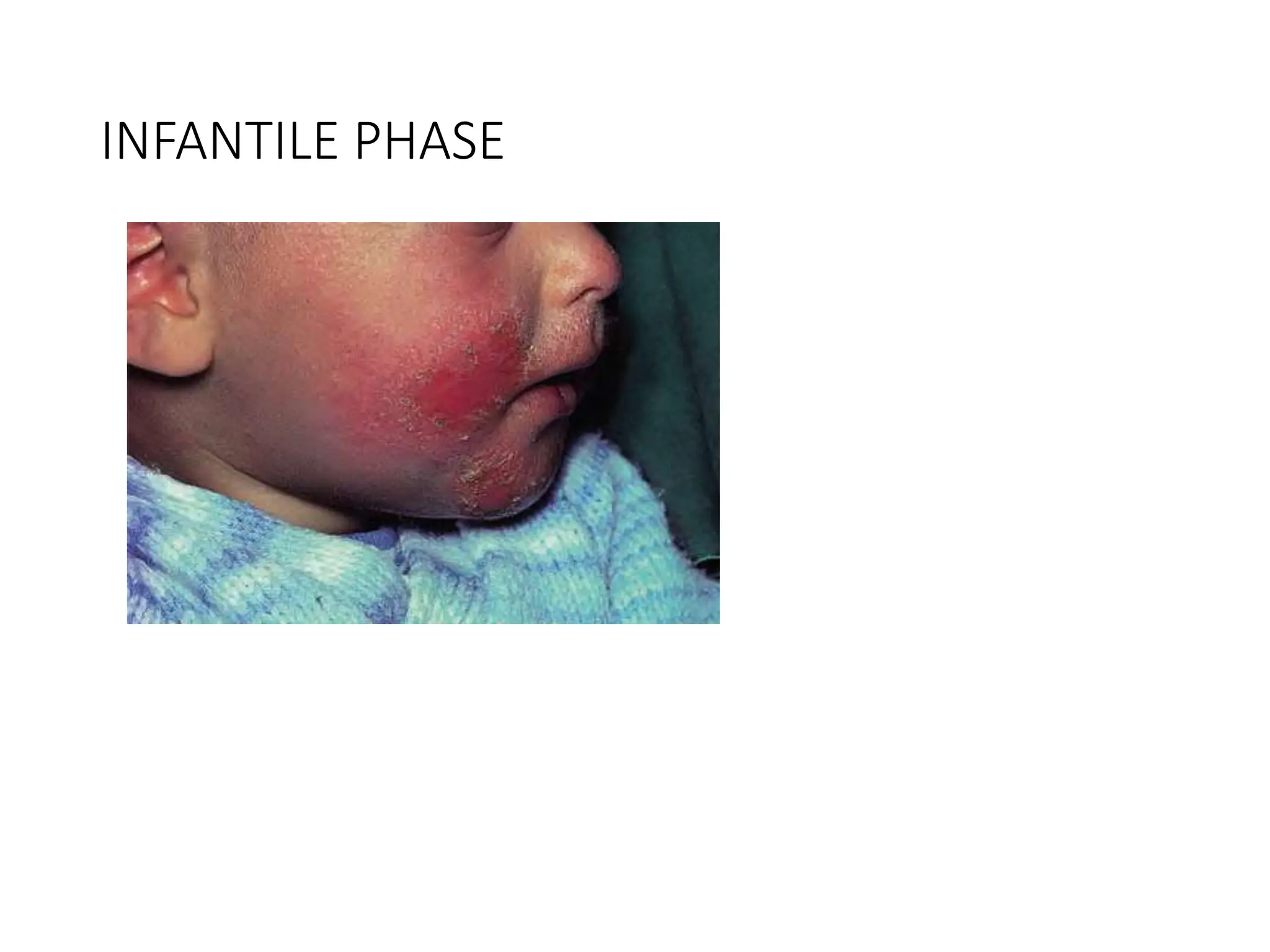 Pathogenesis clinical features and management of Atopic dermatitis ...