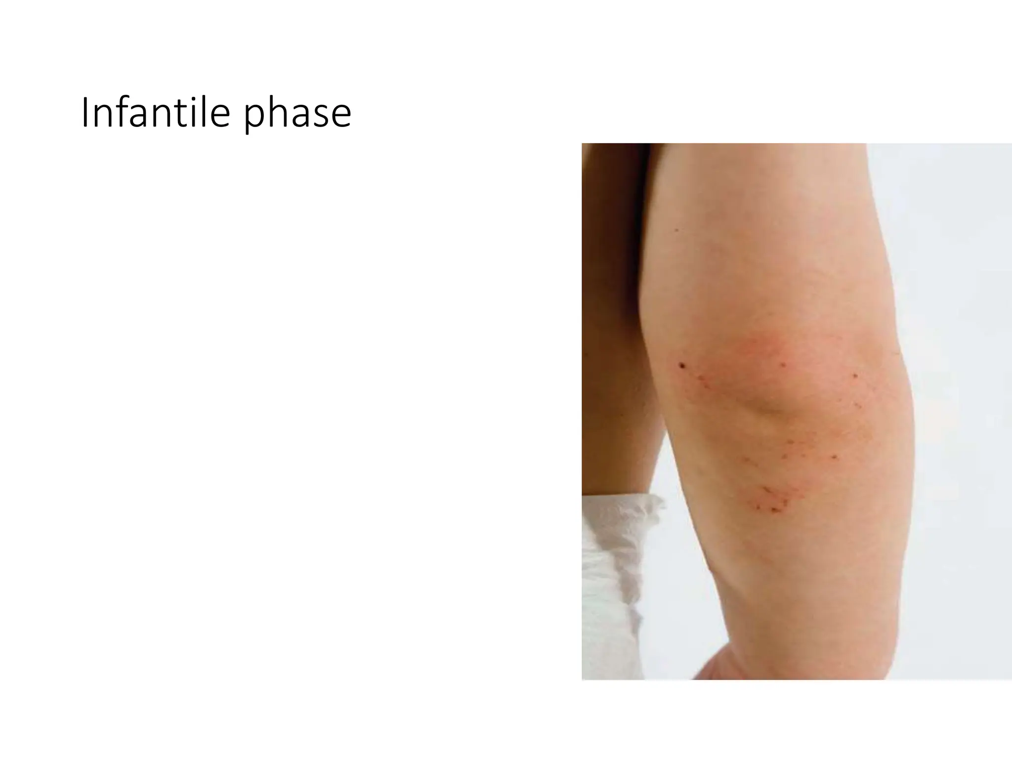 Pathogenesis clinical features and management of Atopic dermatitis ...