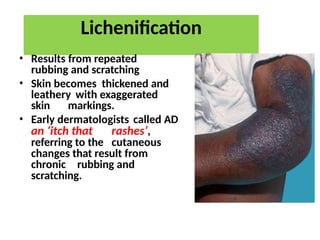 atopicdermatitis new ppt download free and enjoy | PPTX