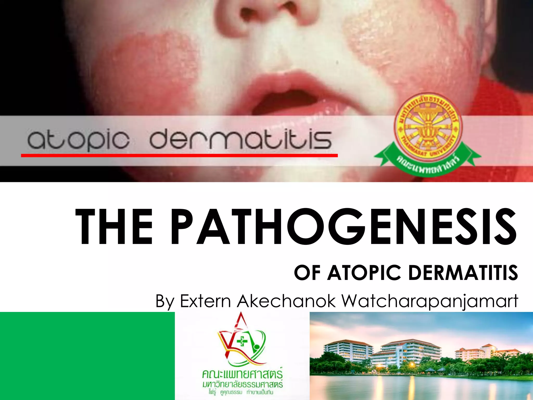 The pathogenesis of Atopic dermatitis | PPT
