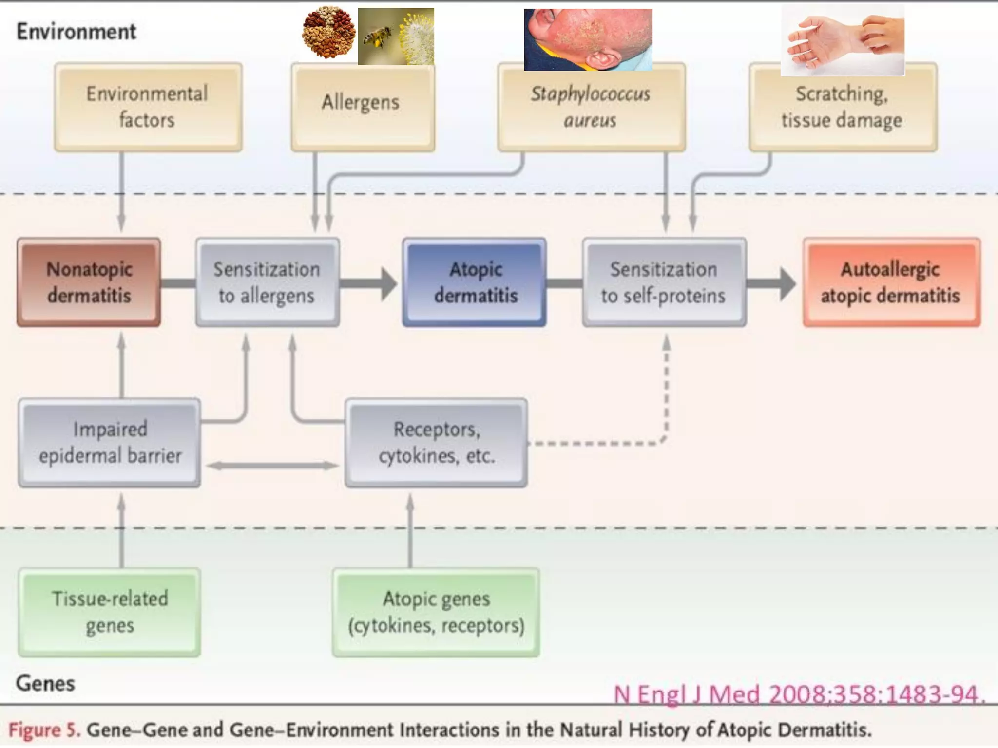 The pathogenesis of Atopic dermatitis | PPT