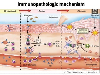 The pathogenesis of Atopic dermatitis