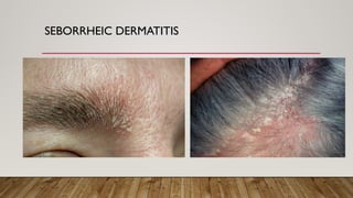 Atopic dermatitis,eczema, Etiology, pathology, diagnosis, management ...