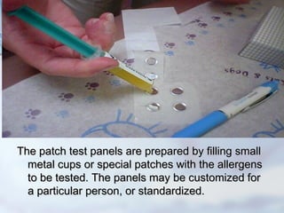 Atopy patch test | PPT
