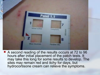 Atopy patch test | PPT