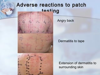 Atopy patch test | PPT