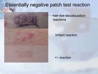 Atopy patch test | PPT