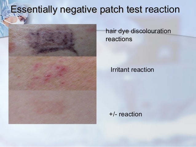 Atopy Patch Test