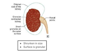 Chronic Glomerulonephritis - Pathology - ATOT | PPTX