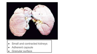 Chronic Glomerulonephritis - Pathology - ATOT | PPTX