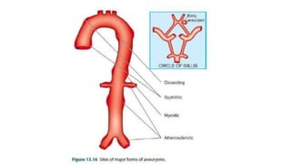 Aneurysms - Pathology - ATOT | PPTX
