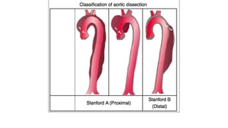 Aneurysms - Pathology - ATOT | PPTX