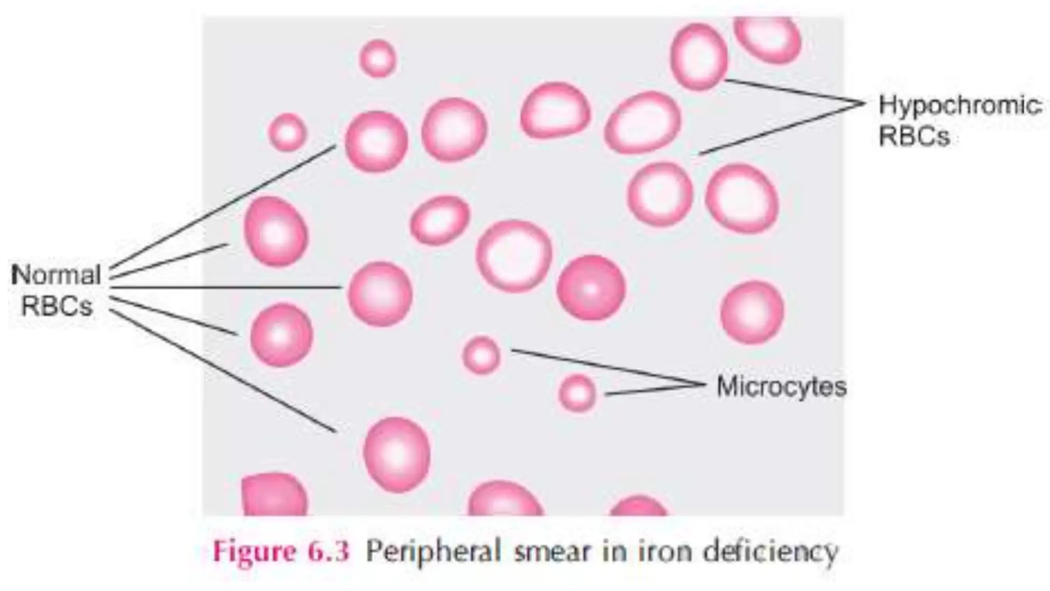 Anemia: classification, IDA, Megaloblastic anemia - General Medicine ...