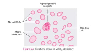 Anemia: classification, IDA, Megaloblastic anemia - General Medicine ...