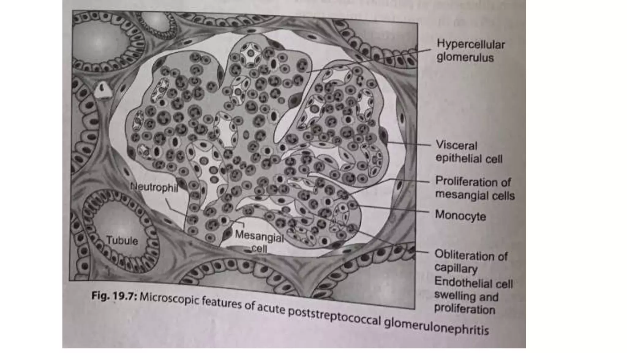 Nephritic syndrome, Acute glomerulonephritis - Pathology - ATOT | PPTX ...