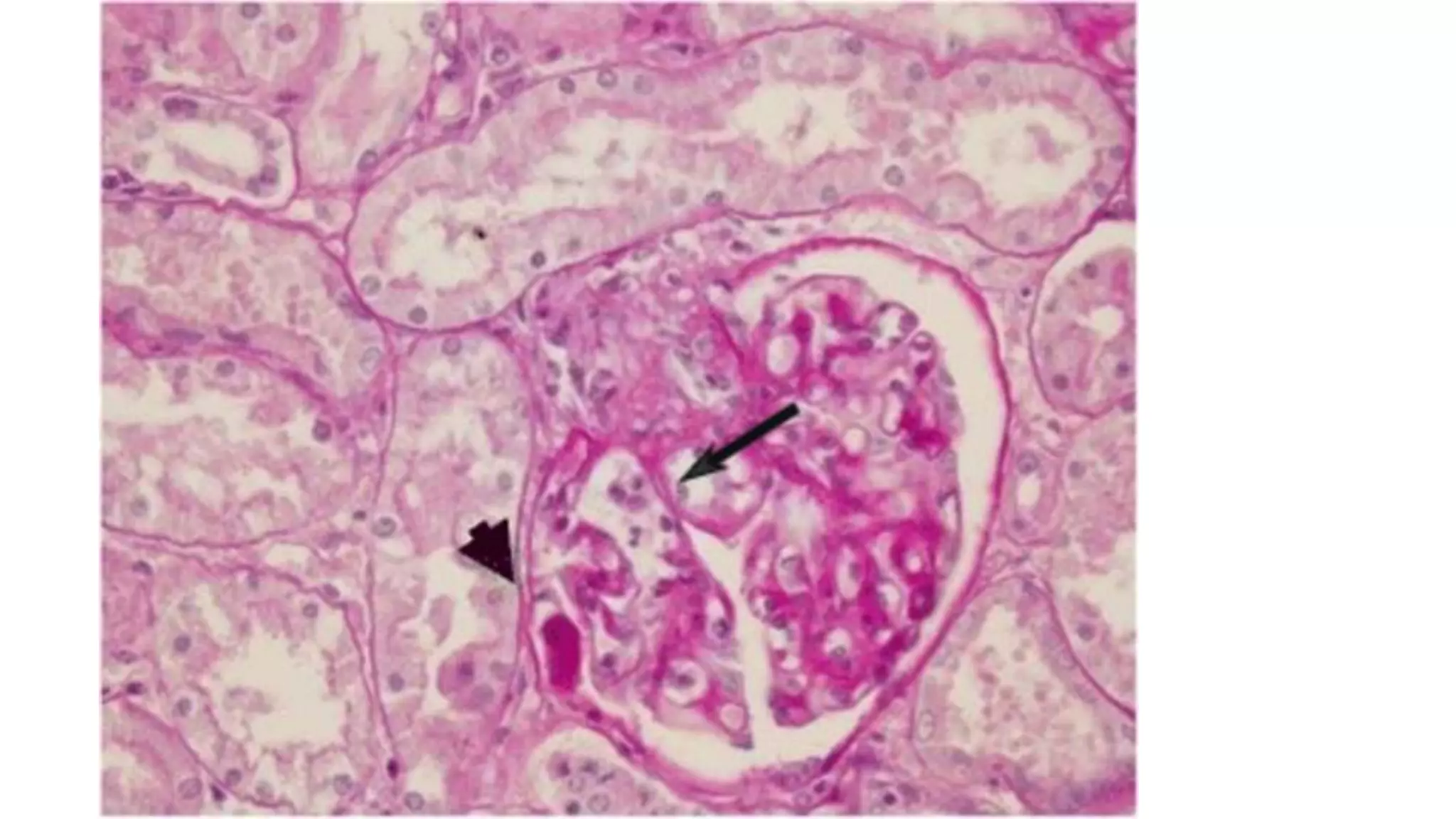 Nephritic syndrome, Acute glomerulonephritis - Pathology - ATOT | PPTX ...