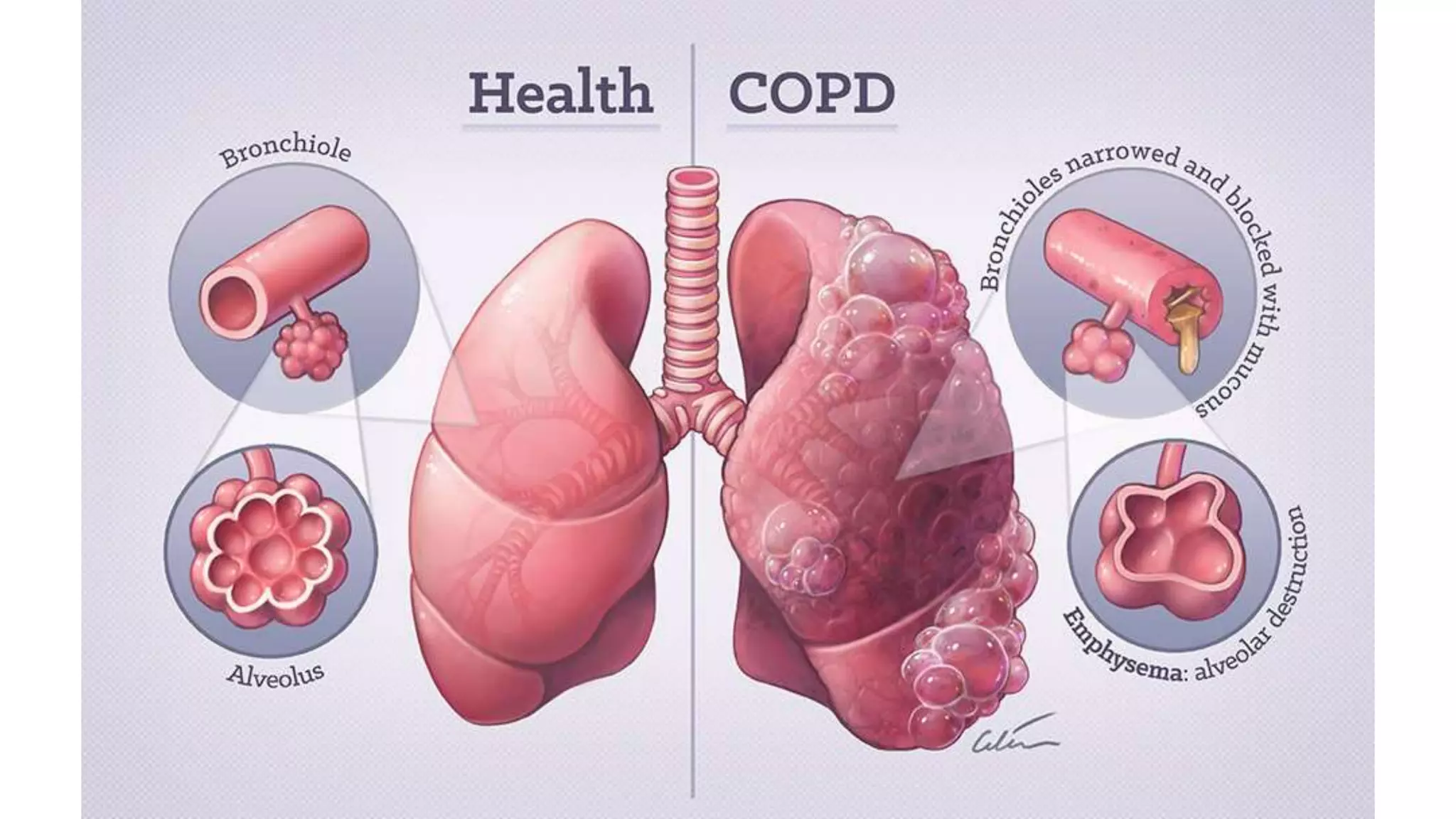 Obstructive vs Restrictive Pulmonary Disease - Pathology - ATOT | PPTX