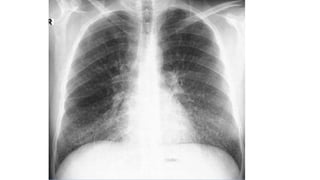 Obstructive vs Restrictive Pulmonary Disease - Pathology - ATOT | PPTX