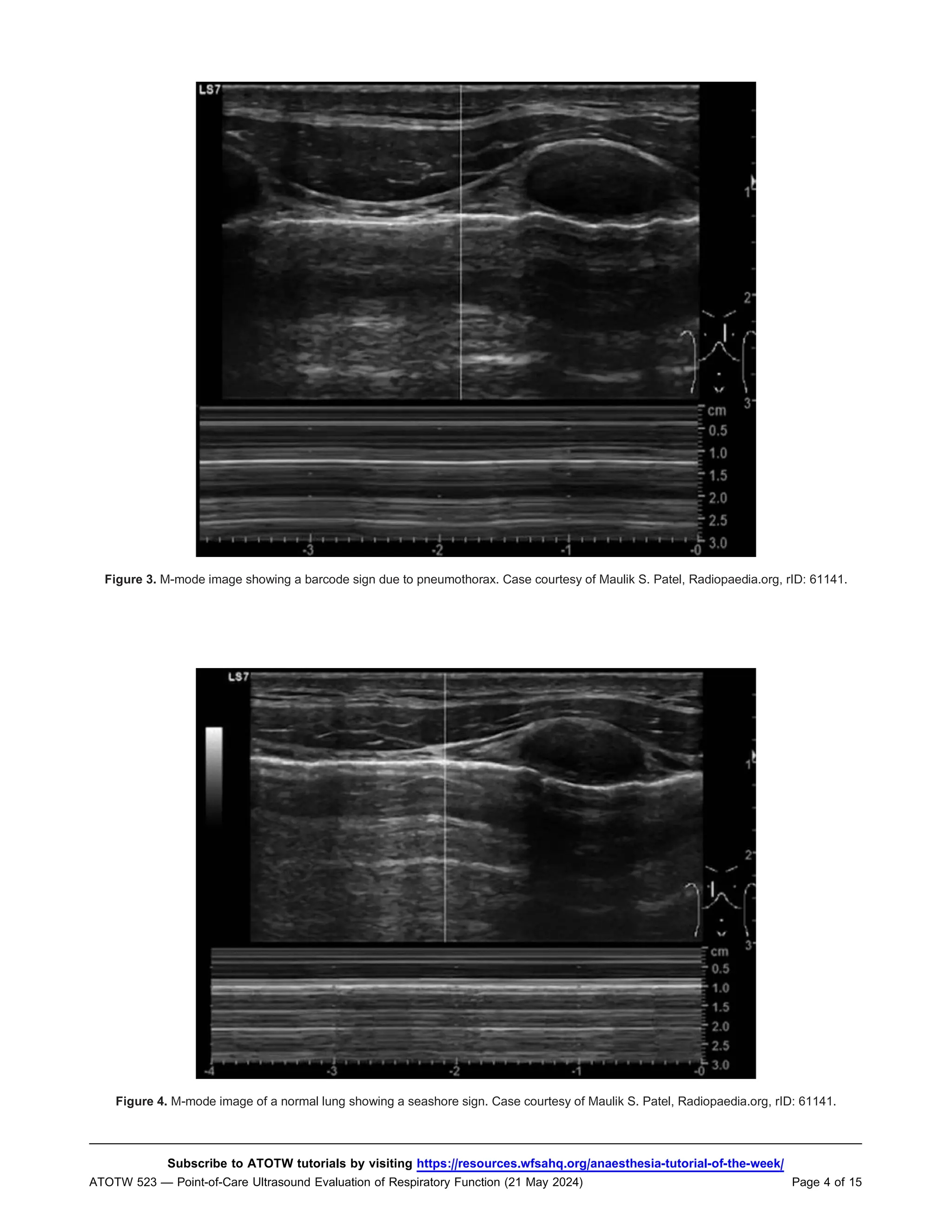 Point-of-Care Ultrasound Evaluation of Respiratory Function.pdf