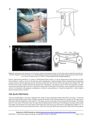 Point-of-Care Ultrasound Evaluation of Respiratory Function.pdf
